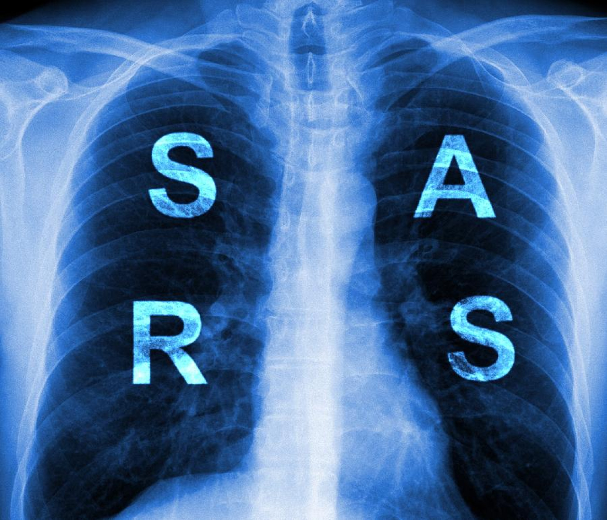 Sokan a SARS miatt félnek az új koronavírustól | Cool.hu
